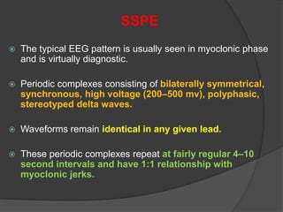 Periodic lateralized epileptiform discharges | PPTX