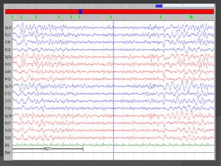 Periodic lateralized epileptiform discharges | PPTX