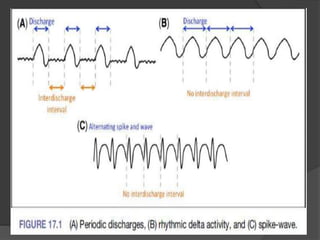 Periodic lateralized epileptiform discharges | PPTX