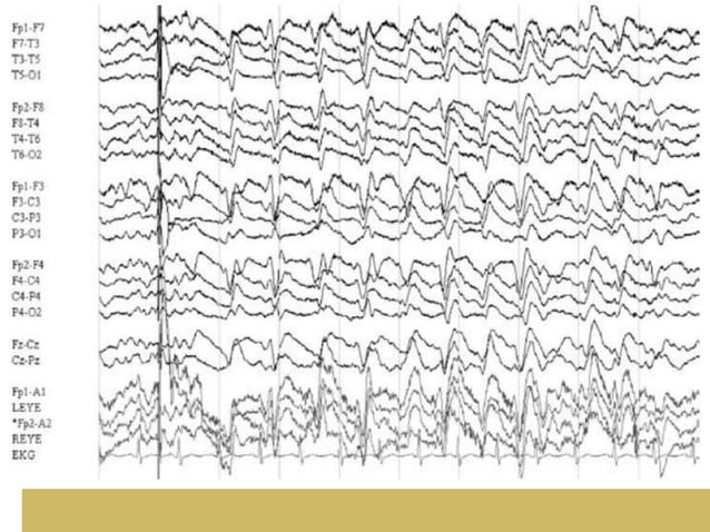 PLEDS | PPTX