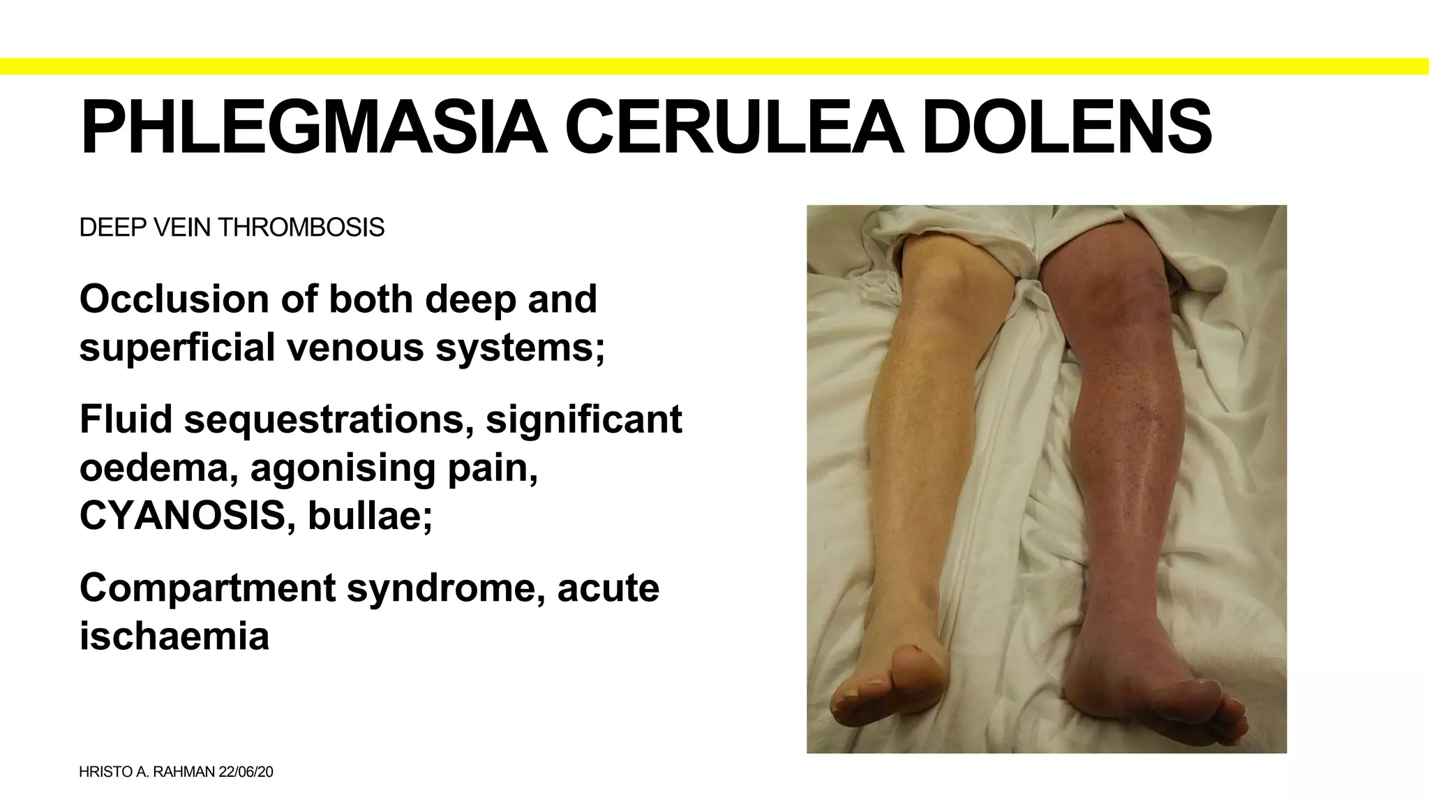 Phlegmasia Cerulea Dolens