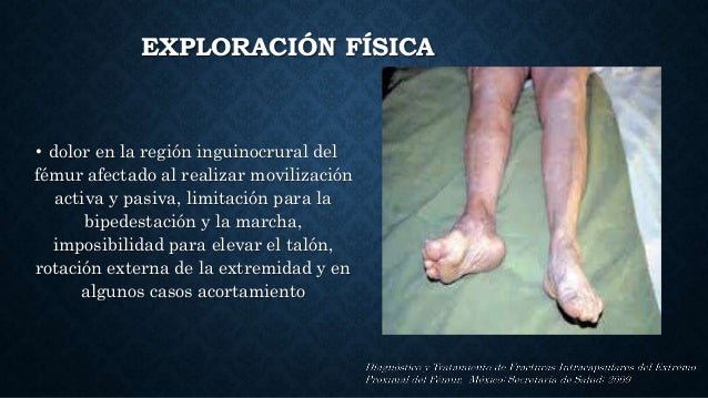 Fractura De Cadera