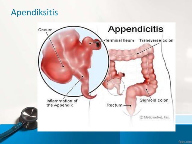 apendiksitis | PPTX