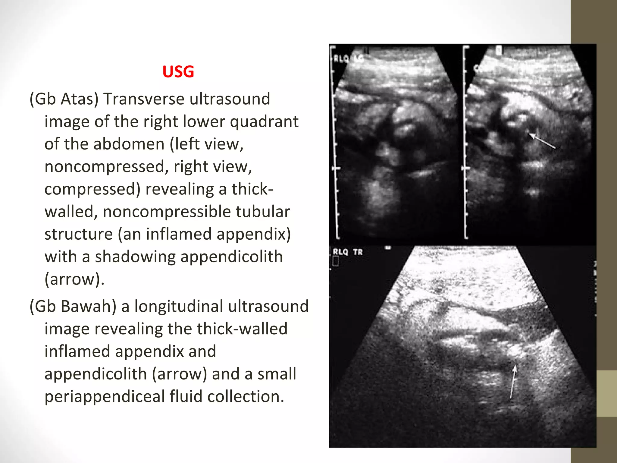 gawat abdomen | PPT