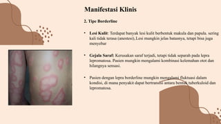 "Analisis Kasus Lepra pada Pasien dengan Gejala Baal dan Manifestasi ...