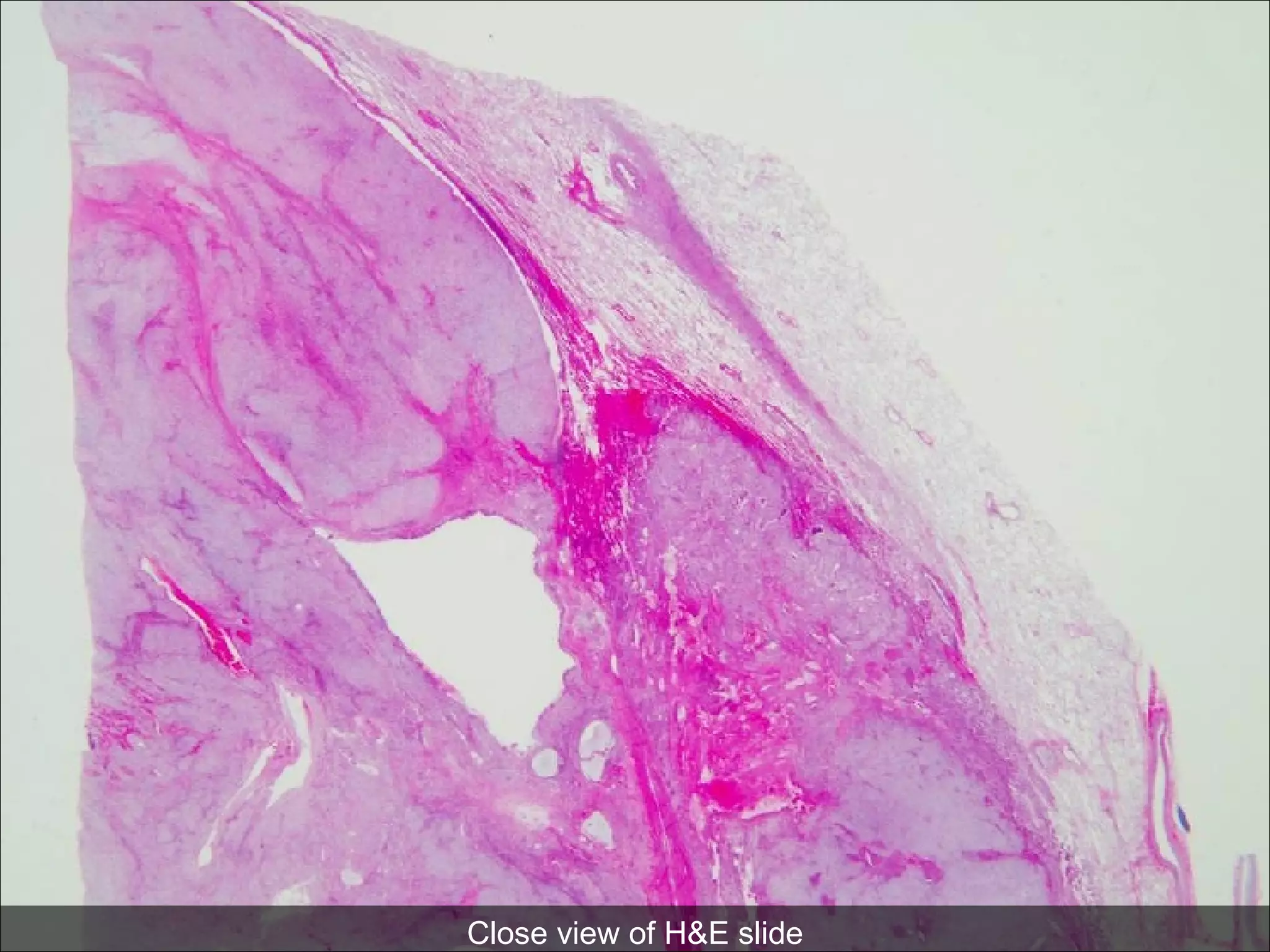 Pleomorphic Carcinoma Smc | PPT