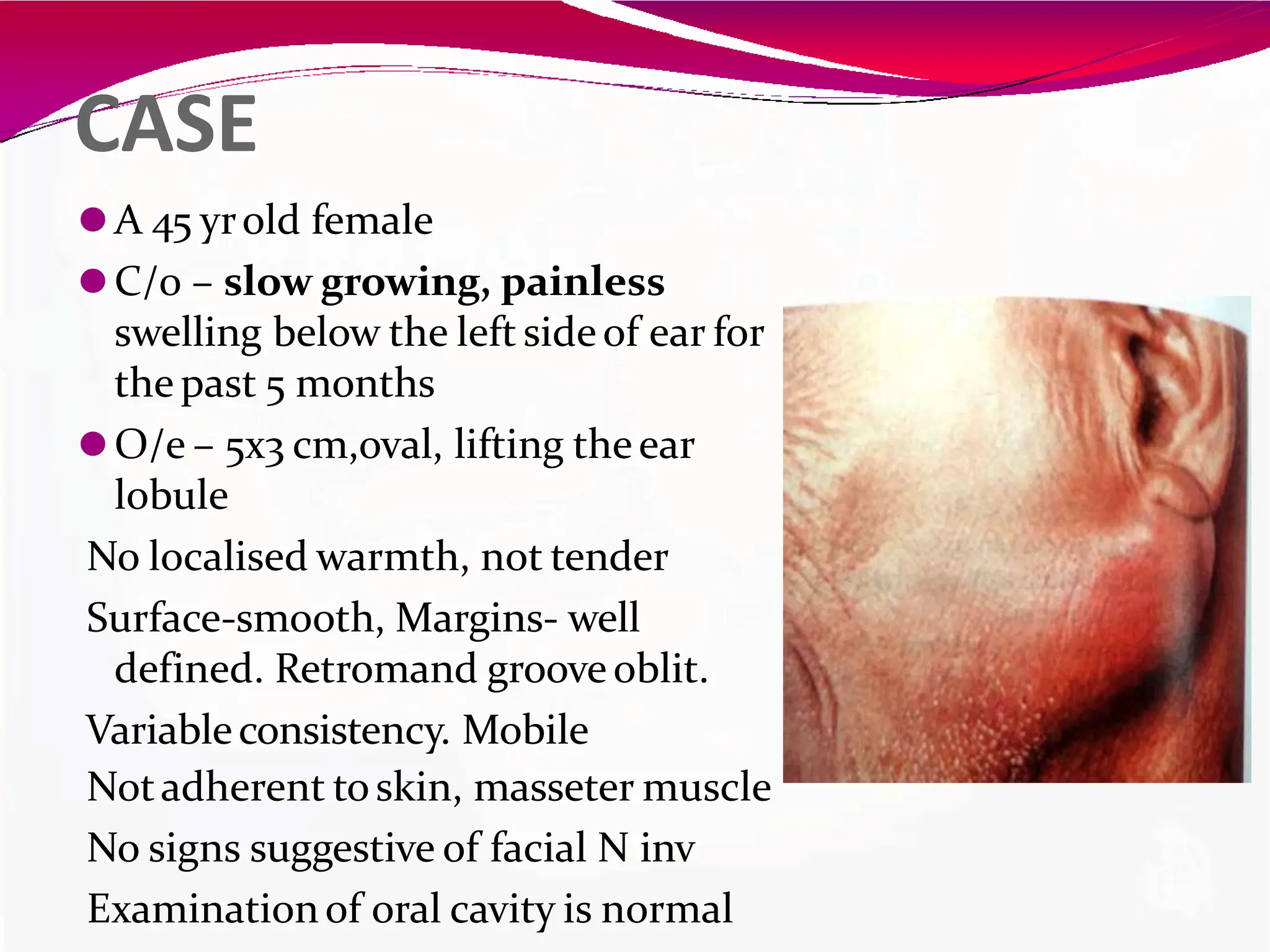 pleomorphic adenoma major salivary .pptx