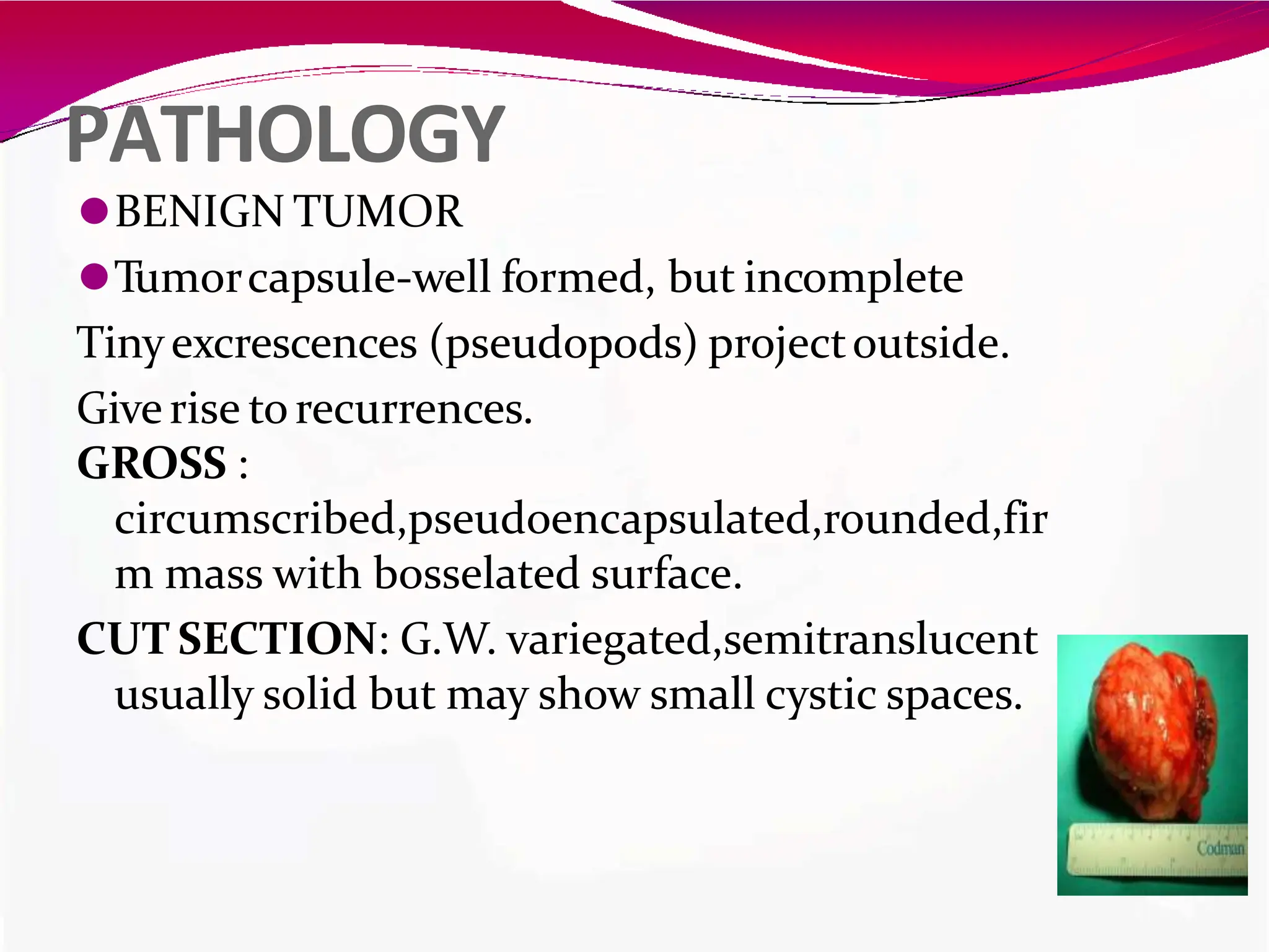 pleomorphic adenoma major salivary .pptx