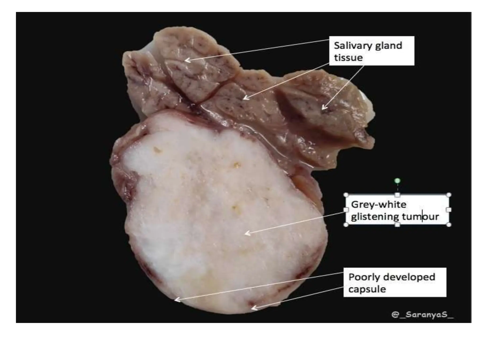 pleomorphic adenoma major salivary .pptx