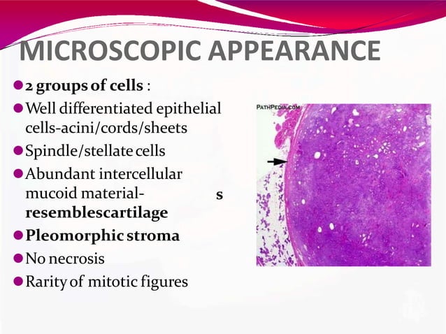 pleomorphic adenoma major salivary .pptx | Ear, Nose and Throat ...