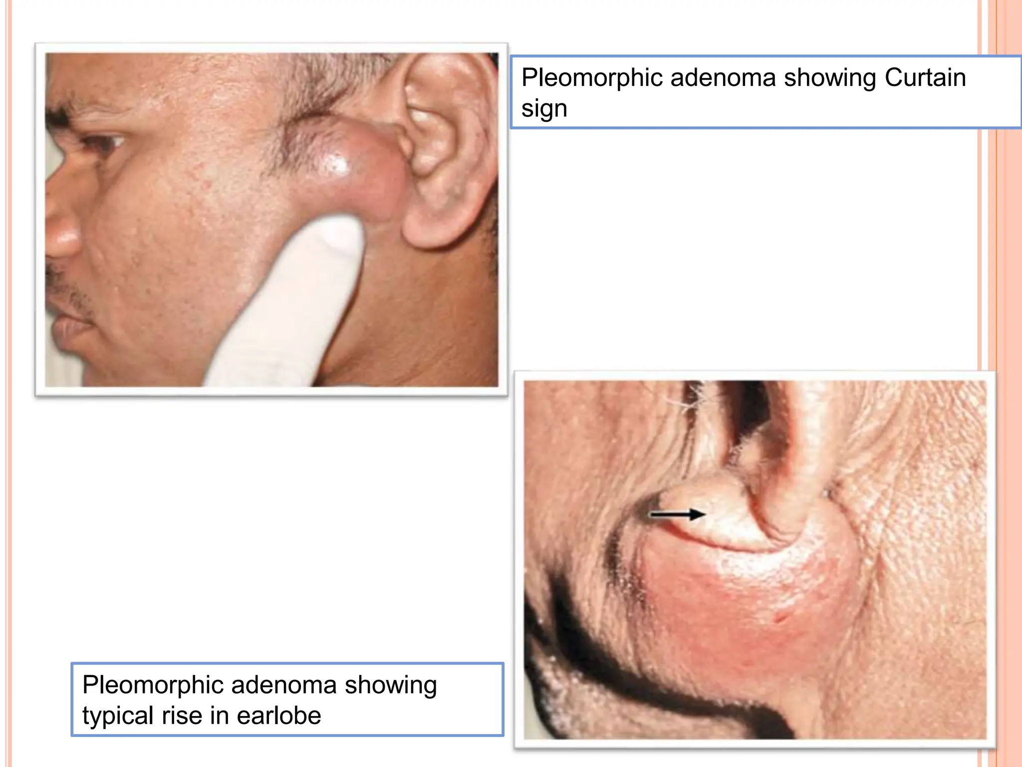 PLEOMORPHIC ADENOMA presentaion sss.pptx