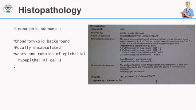 Pleomorphic adenoma of minor salivary gland revised | PPT