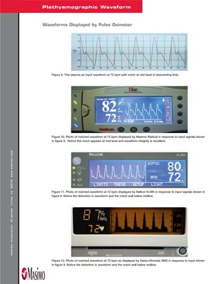 Plethysmographic waveform | PDF | Digital Audio | Computer Software and ...