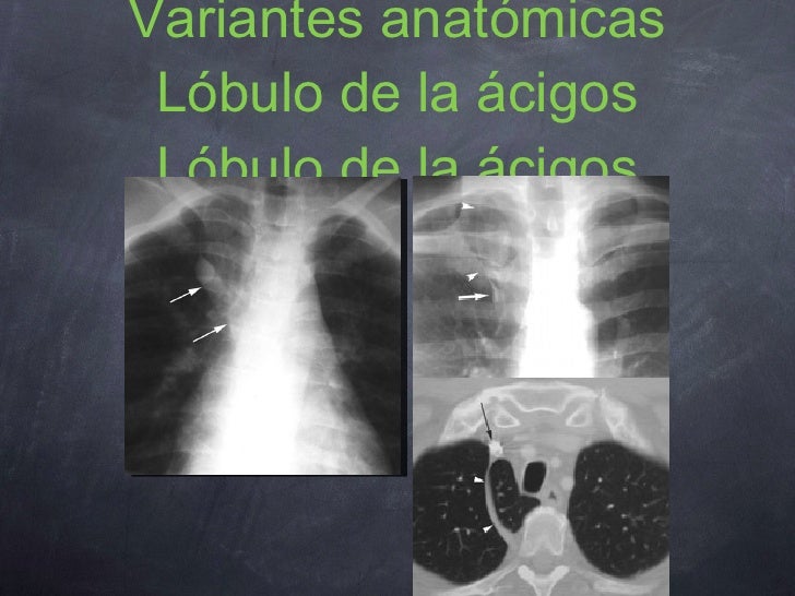 Patología Pleural