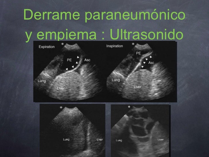 Patología Pleural
