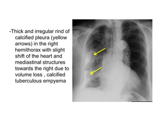 Diagnostic Imaging of Pleural Lesions | PPT