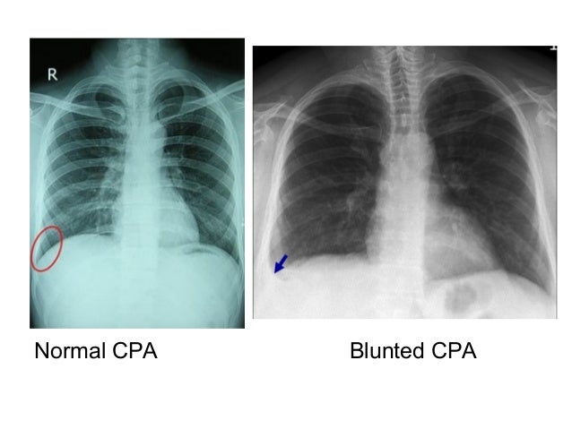Diagnostic Imaging of Pleural Lesions