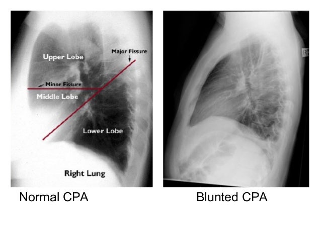 Diagnostic Imaging of Pleural Lesions