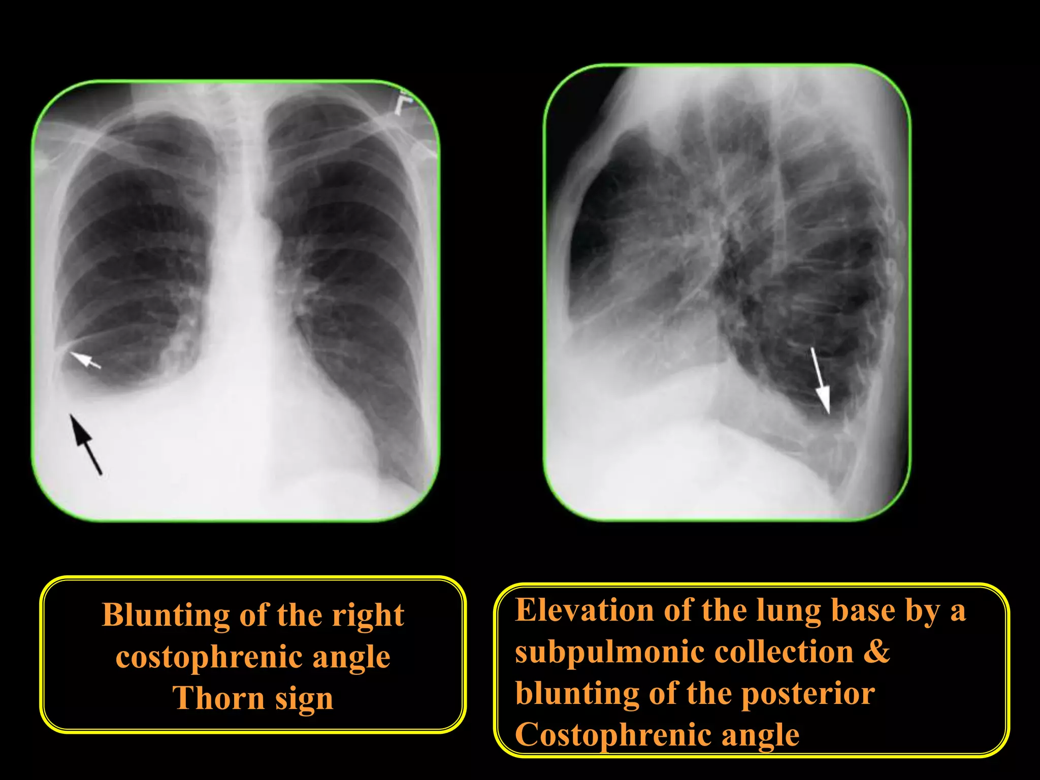 Pleura Diseases | PPTX