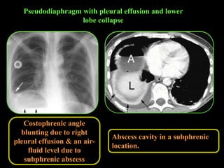 Pleura Diseases | PPTX