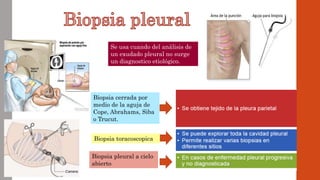 DERRAME PLEURAL CUADRO CLINICO SINTOMAS.pptx