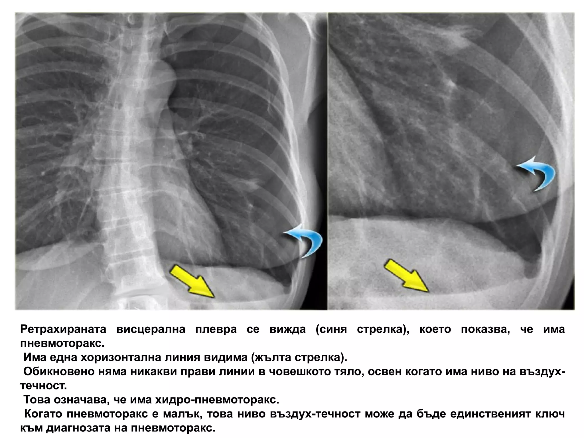 Pleura and diaphragm | ODP
