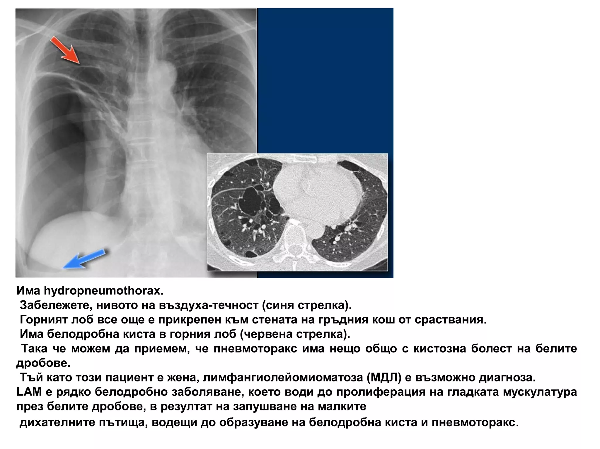 Pleura and diaphragm | ODP