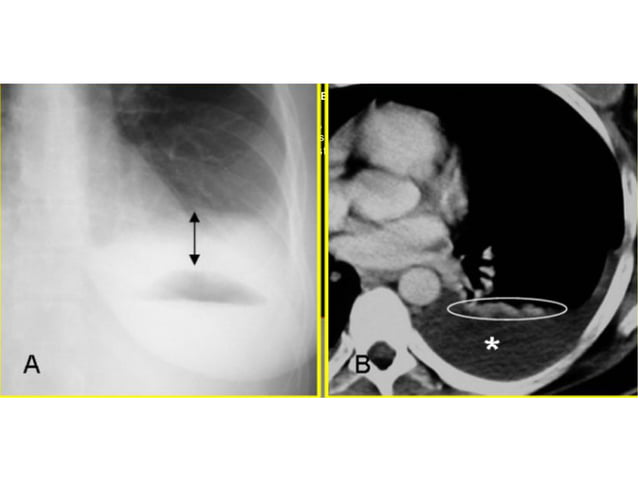 Pleura and diaphragm | PPT