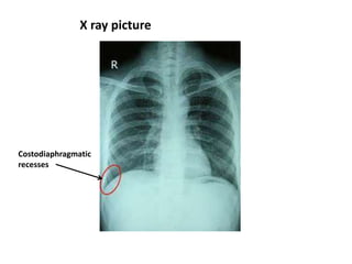 Pleura and its recesses | PPTX