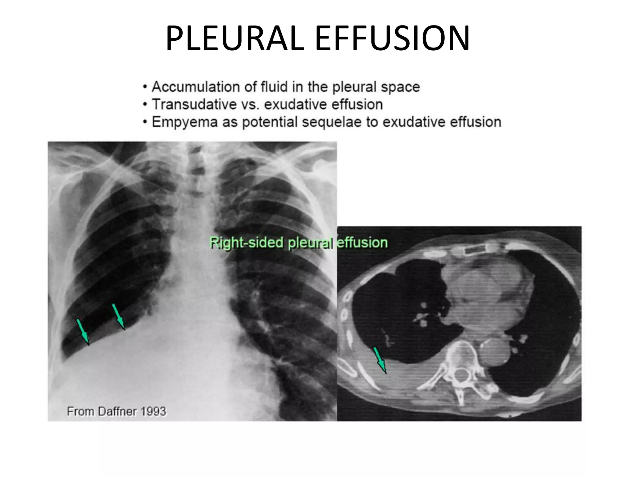 Pleural diseases | PPTX