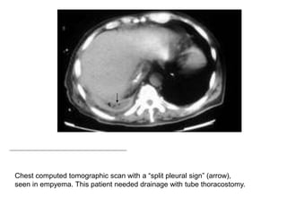 Pleural diseases | PPTX
