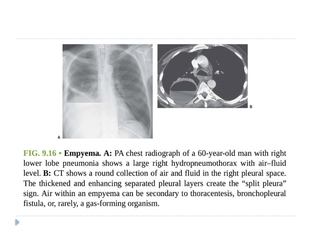 PLEURAL Diseases.Pptx for master students | PPT
