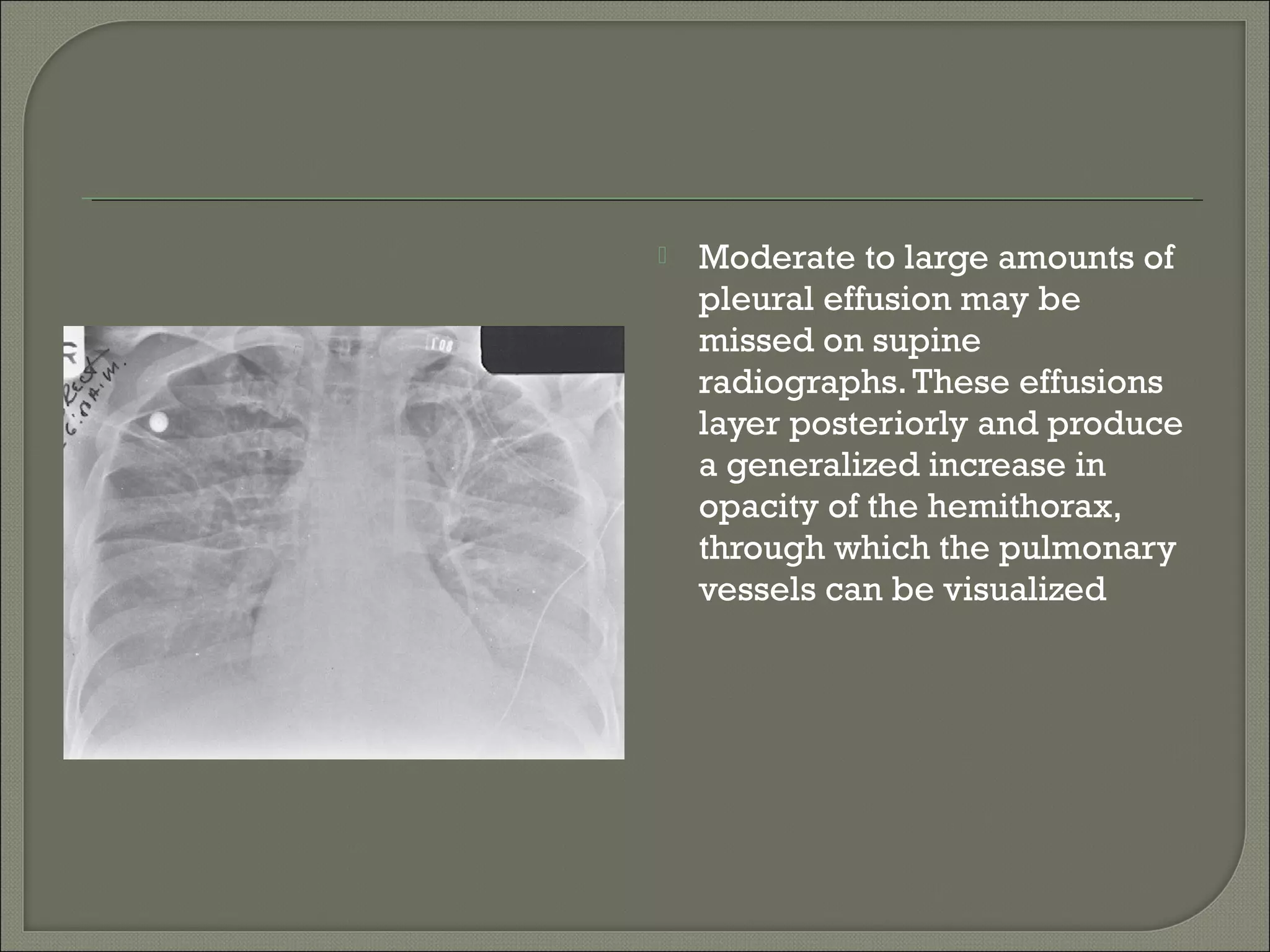 Pleural disorders | PPT