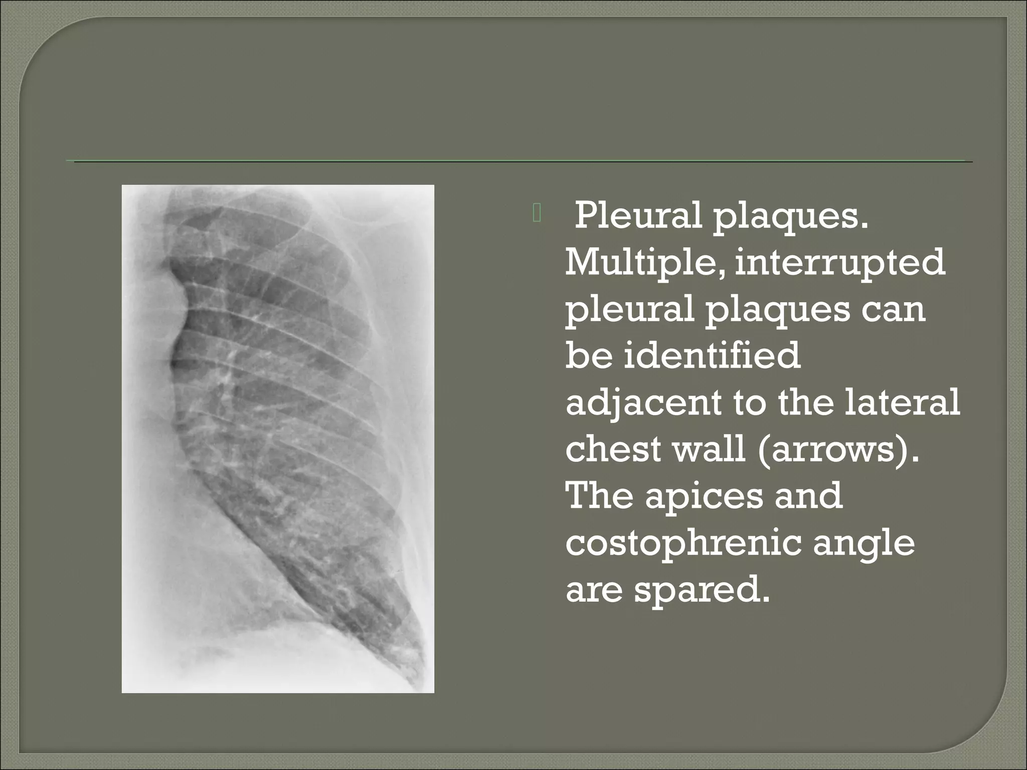 Pleural disorders | PPT