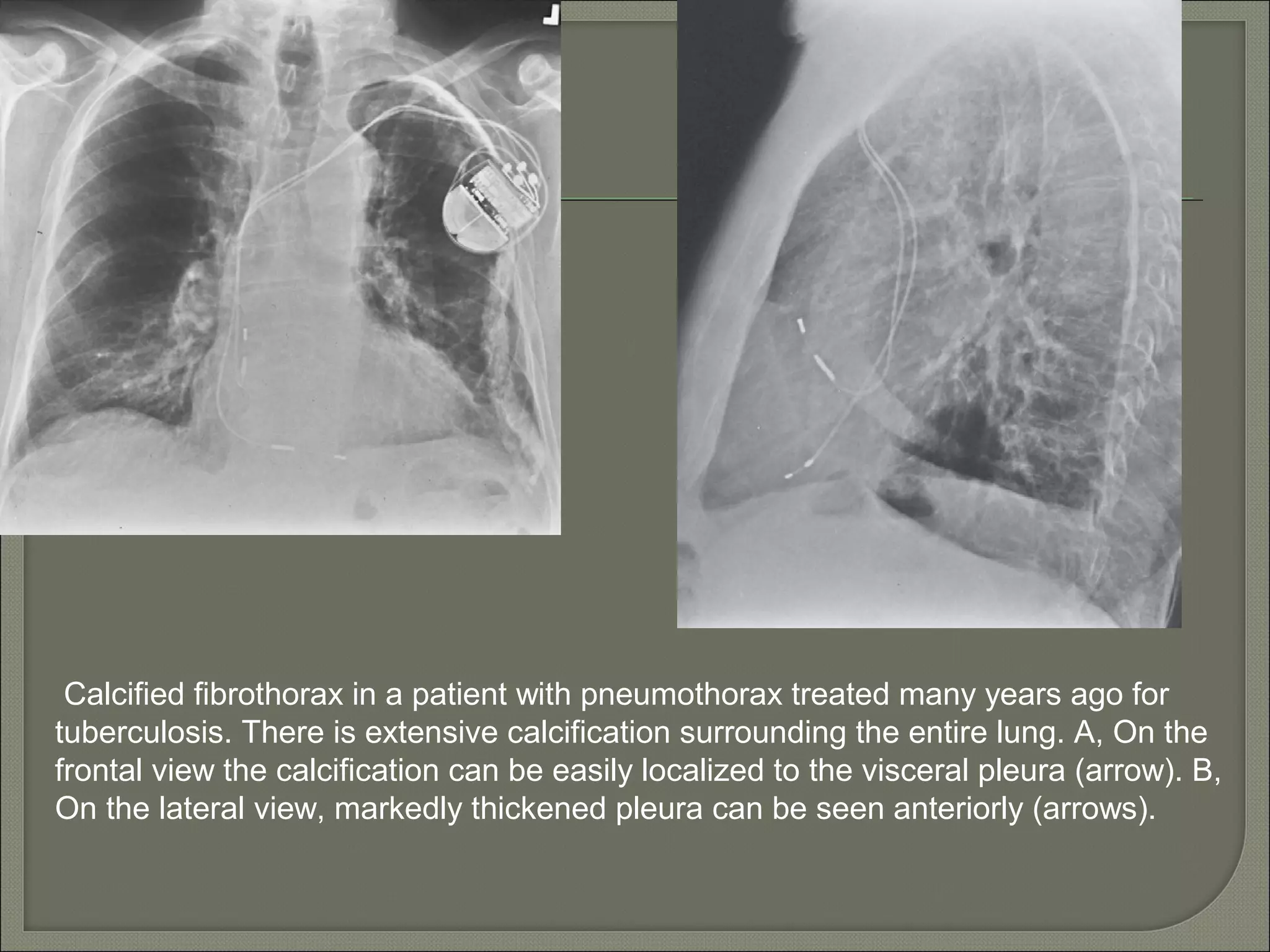 Pleural disorders | PPT