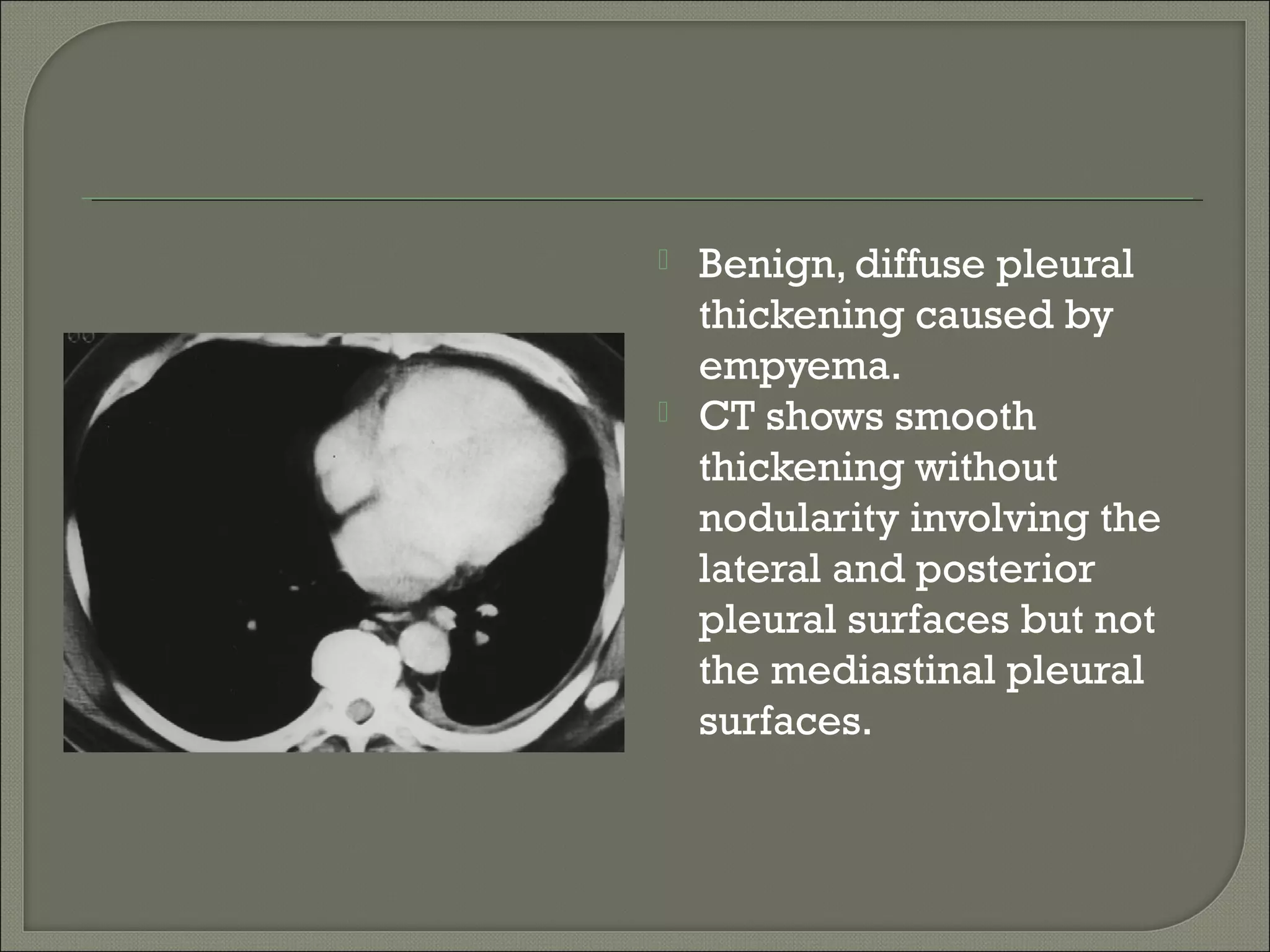 Pleural disorders | PPT