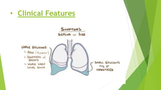 pleural effusion-1.pdf Types, pathophysiology, clinical features ...