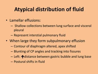 Pleural effusion | PPTX