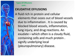 Pleural Effusion | PPTX