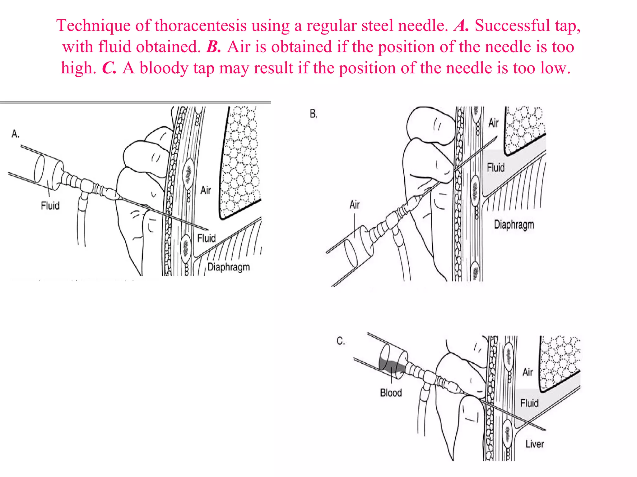 Management of Pleural effusion | PPT