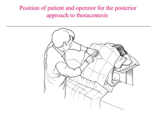 Management of Pleural effusion | PPT
