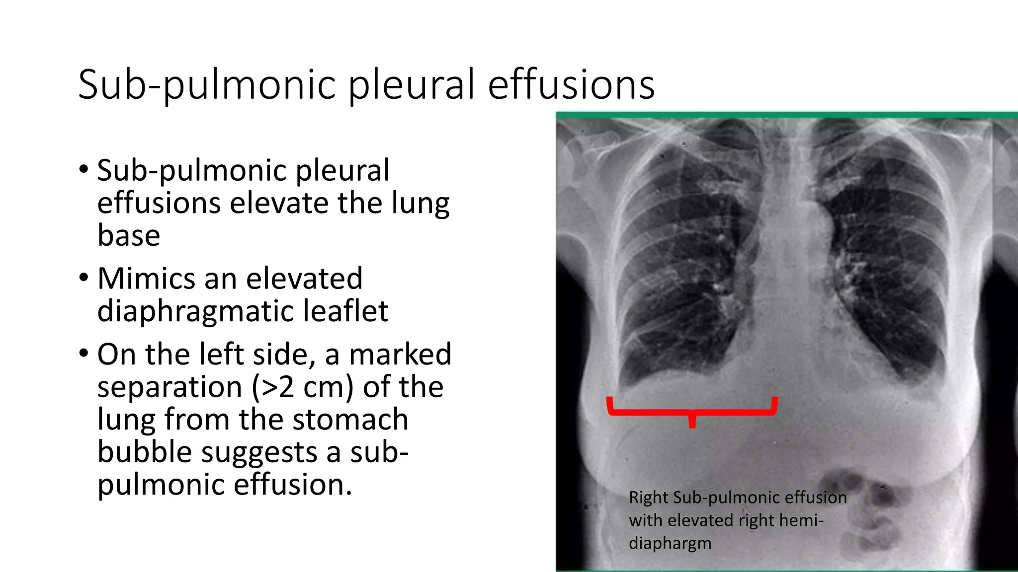 Pleural effusion(X-ray Findings) | PDF