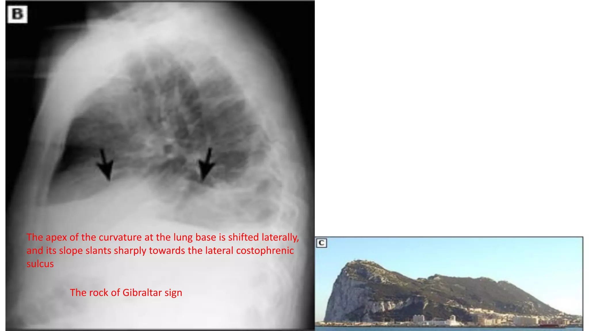 Pleural effusion(X-ray Findings) | PDF