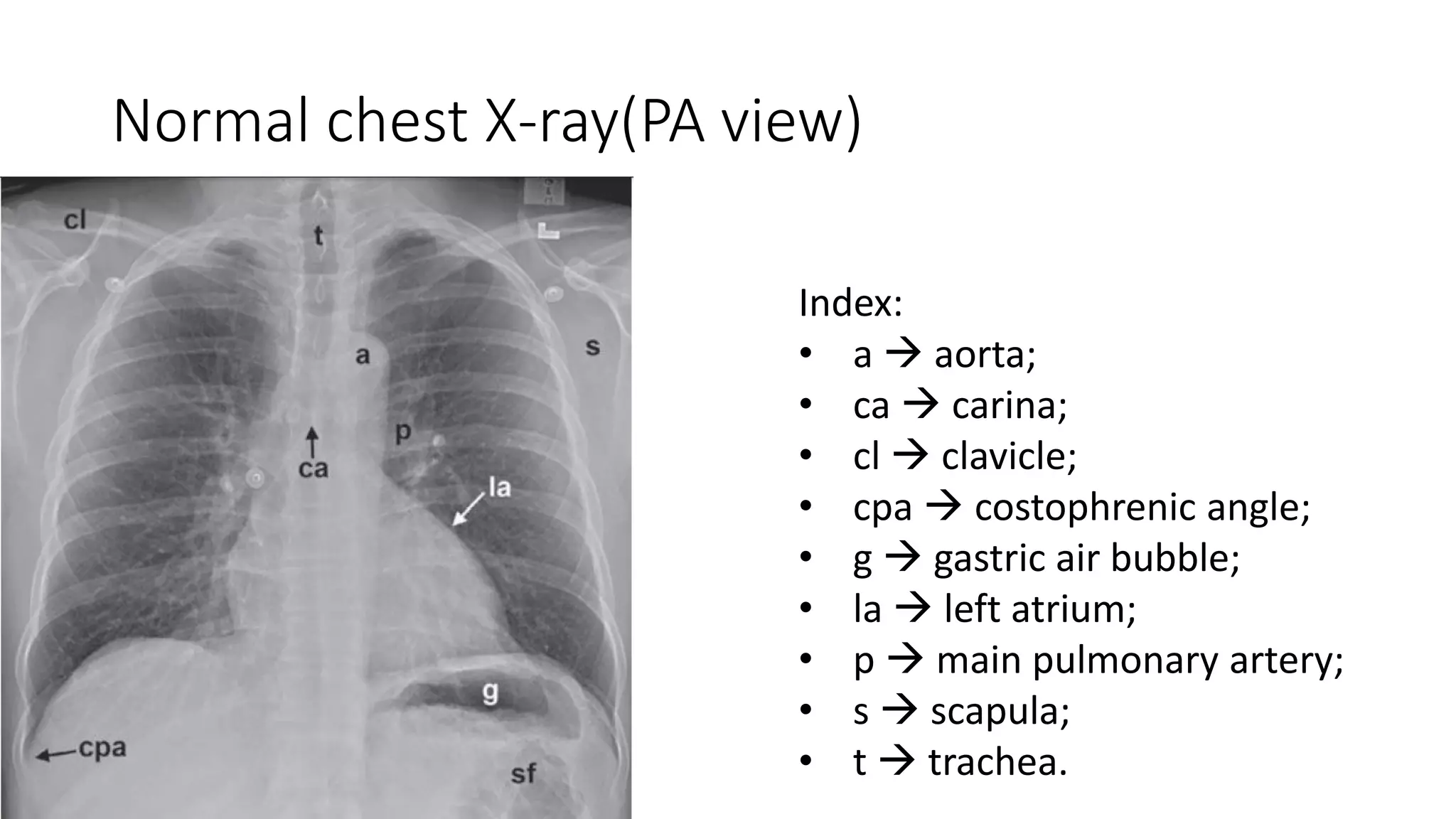 Pleural effusion(X-ray Findings) | PDF