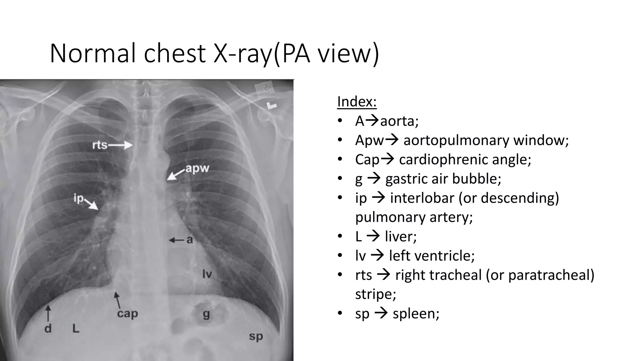 Pleural effusion(X-ray Findings) | PDF