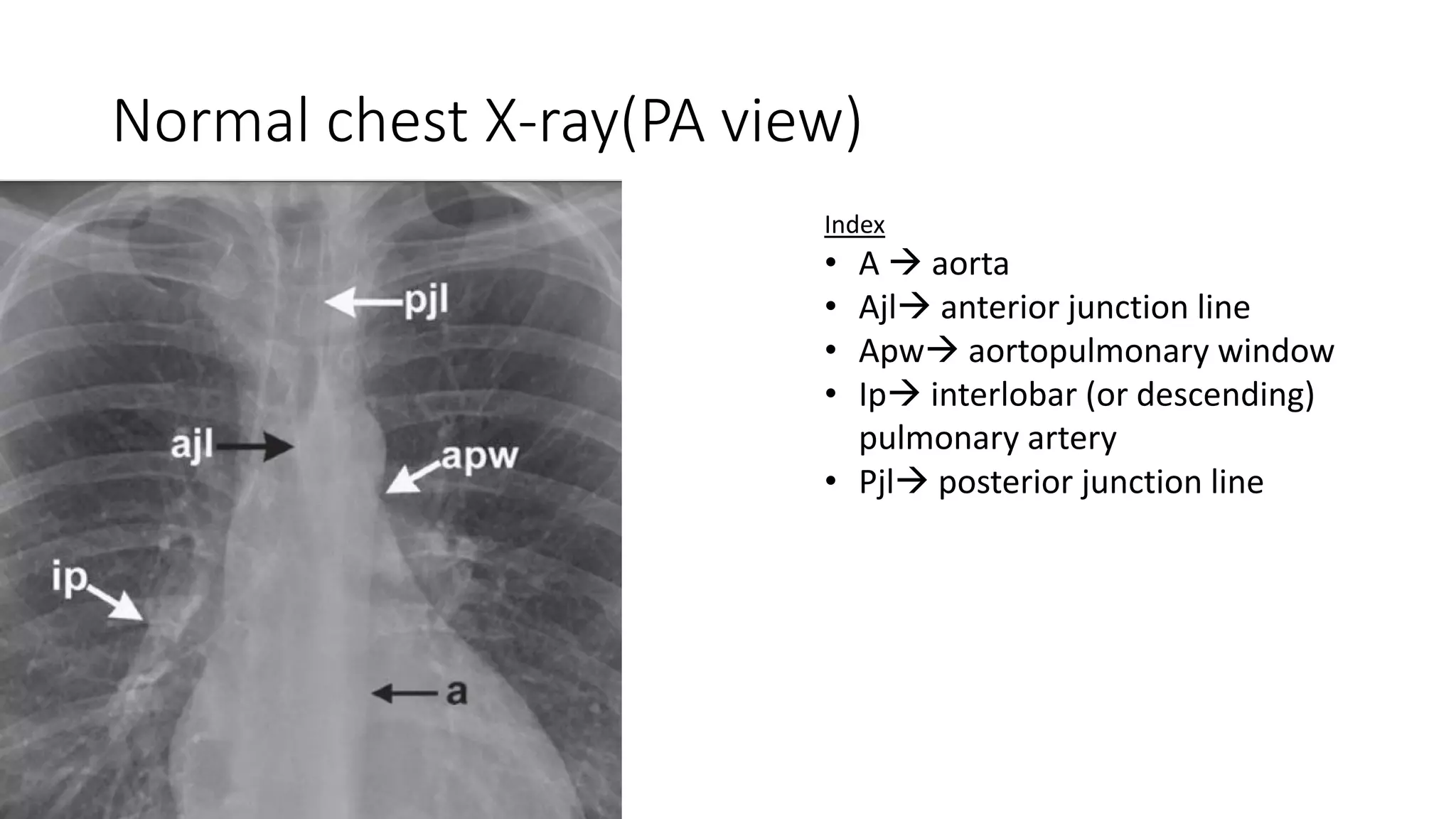 Pleural effusion(X-ray Findings) | PDF