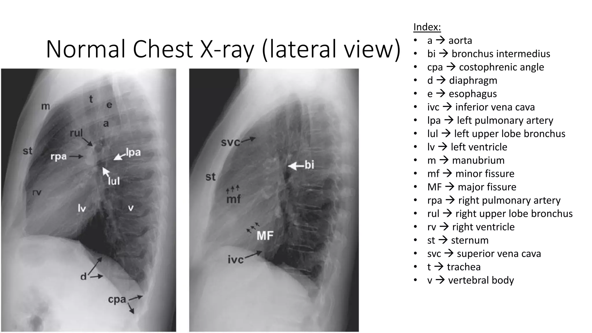 Pleural effusion(X-ray Findings) | PDF