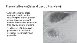 Pleural effusion(X-ray Findings) | PDF