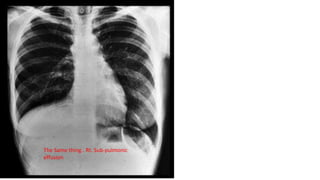Pleural effusion(X-ray Findings) | PDF