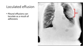 Pleural effusion(X-ray Findings) | PDF